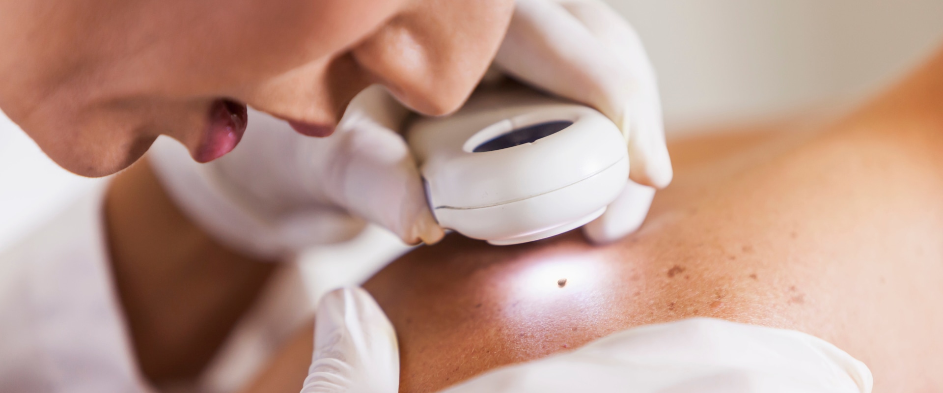 Ligation and Excision: A Guide to Skin Tag Removal