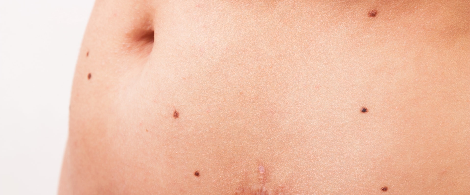 Aftercare Tips for Mole Removal Procedures: Avoiding Trauma to the Area