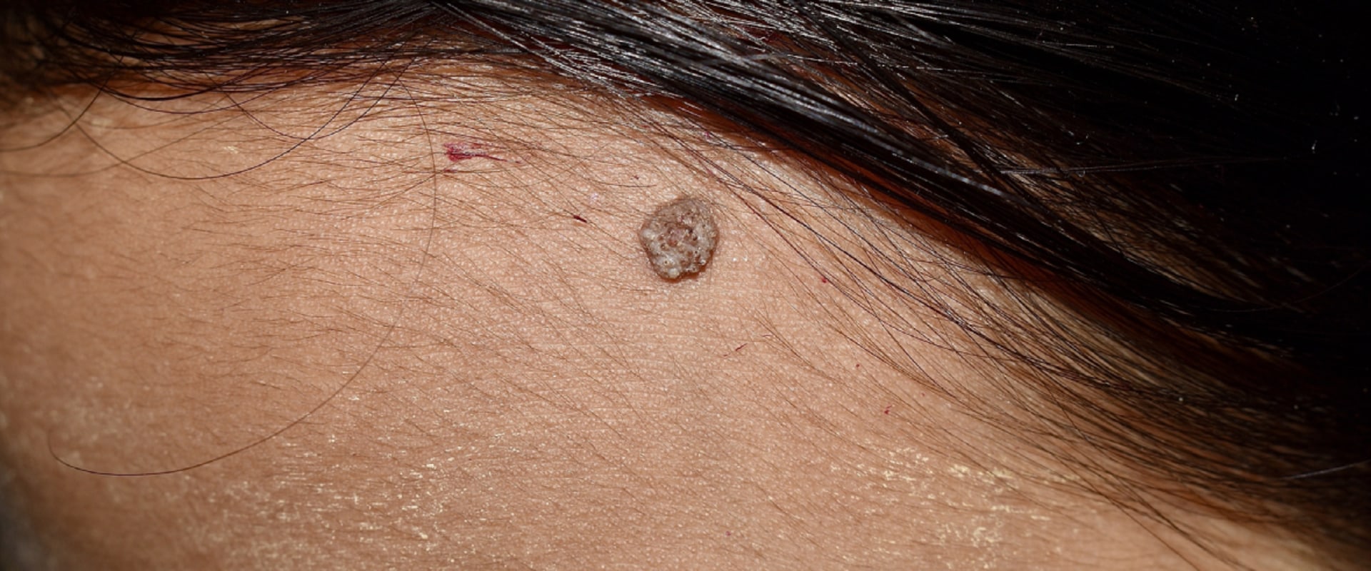 Keeping Your Area Clean and Dry: A Comprehensive Guide to Mole Removal ...