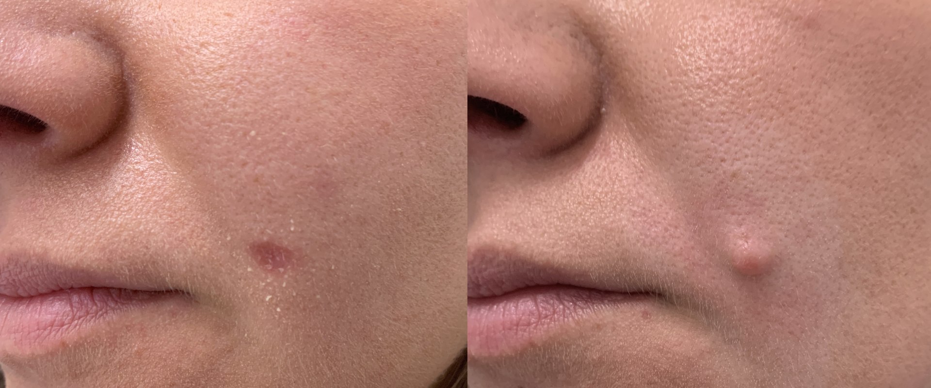 Laser Mole Removal Aftercare: Tips and Advice