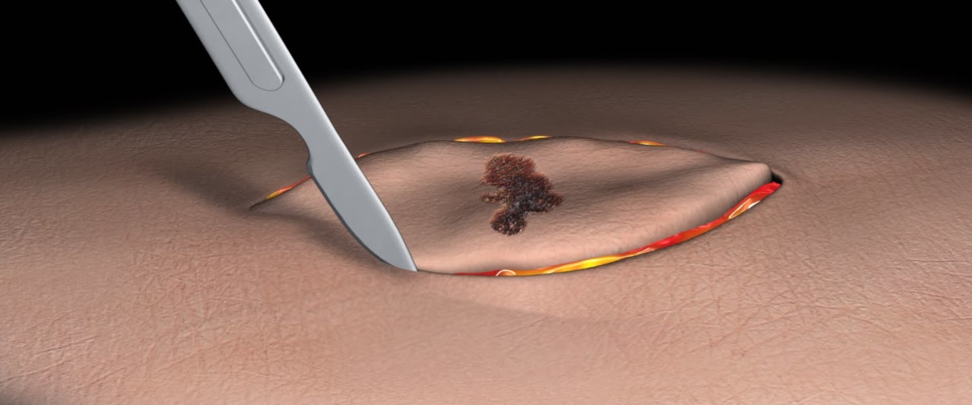Excisional Biopsy Technique: Pros and Cons