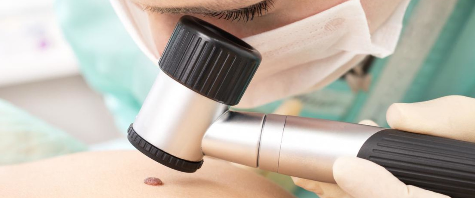 The Benefits of Hydrogen Peroxide Solution for Mole Removal