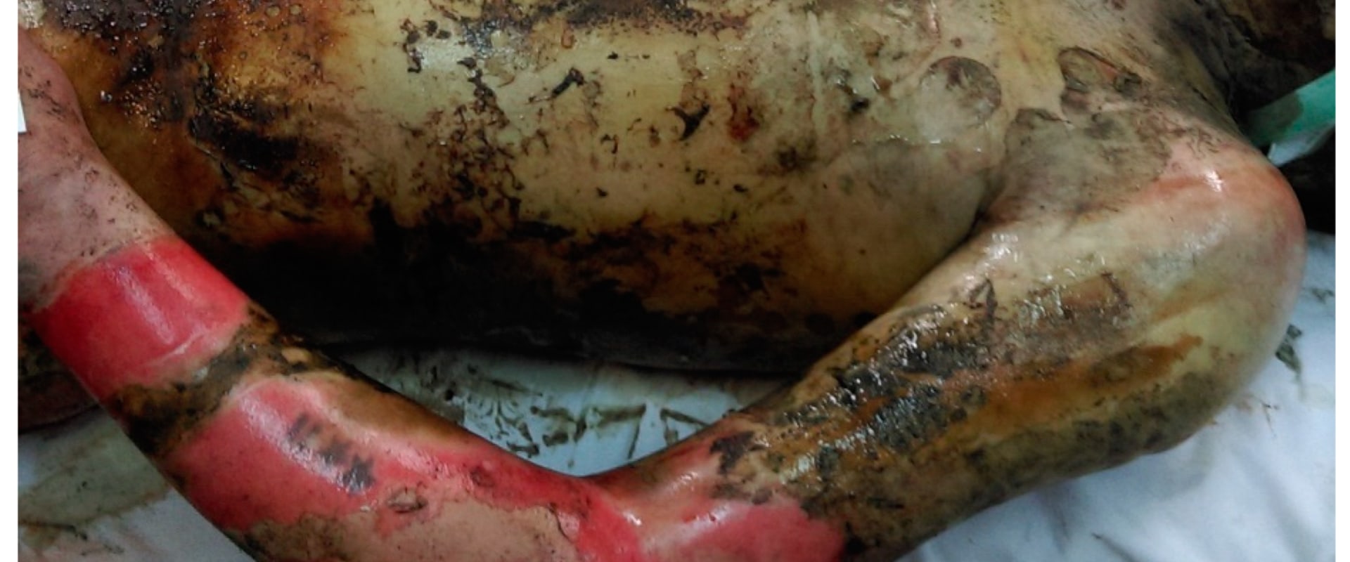 Burning with Acids: A Comprehensive Overview