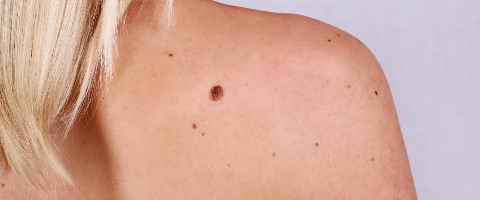 Spot Testing Home Remedies for Mole Removal: Precautions to Take